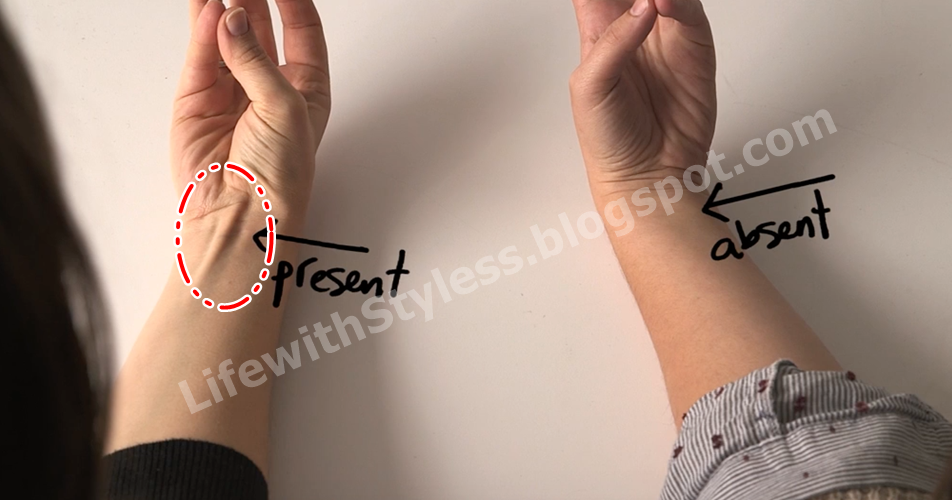 DOES YOUR TENDON PROTRUDE OUT OF YOUR WRIST LIKE THAT. THIS IS WHAT IT ...