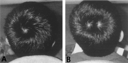 Womb Twin Survivors: Hair whorls and womb twin survivors