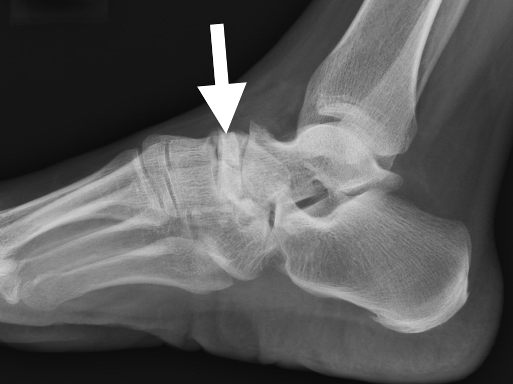 Chia-Wei Lin MD. | 林佳緯 醫師: 足部舟狀骨缺血性壞死 -- Müller-Weiss syndrome