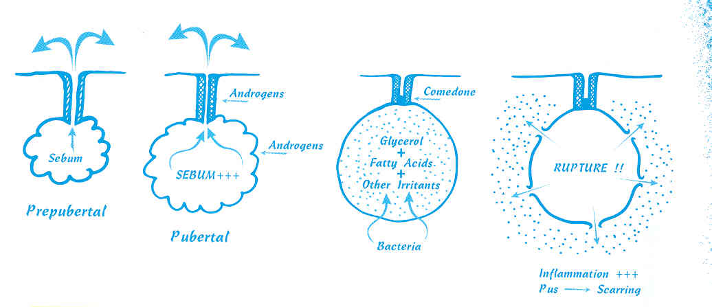 Care for Skin: Easy steps to get rid of Acne