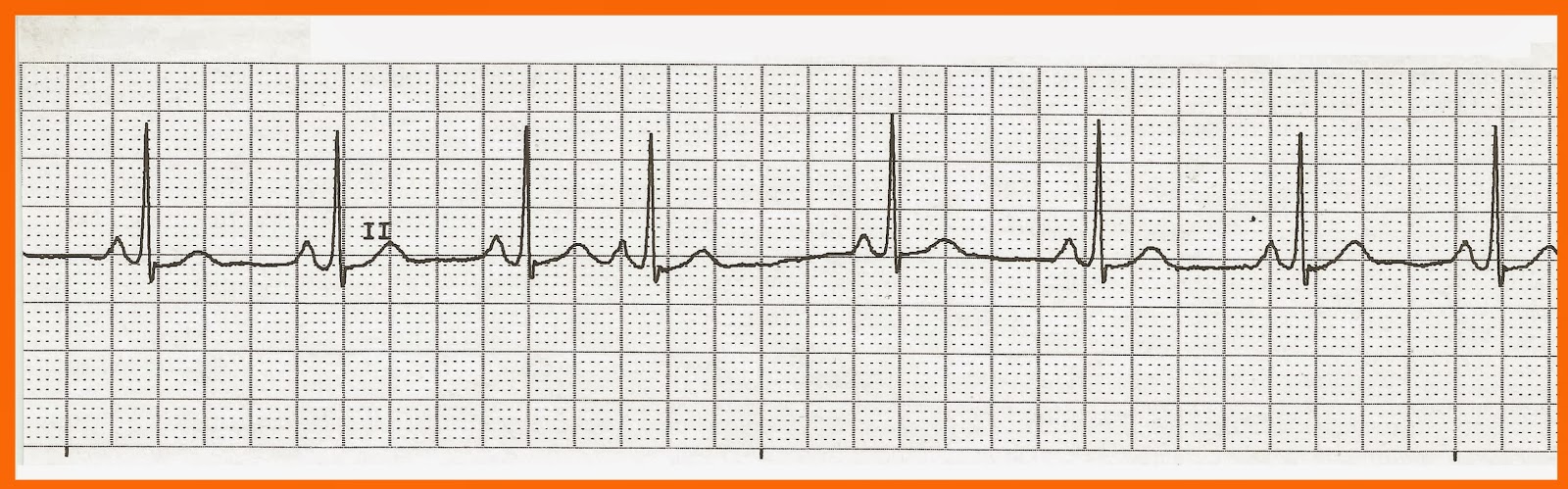 Float Nurse: Practice EKG Rhythm Strips 229