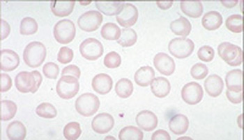 Cuidados UTI: Diagnóstico Diferencial de Anemia Microcítica Hipocrômica
