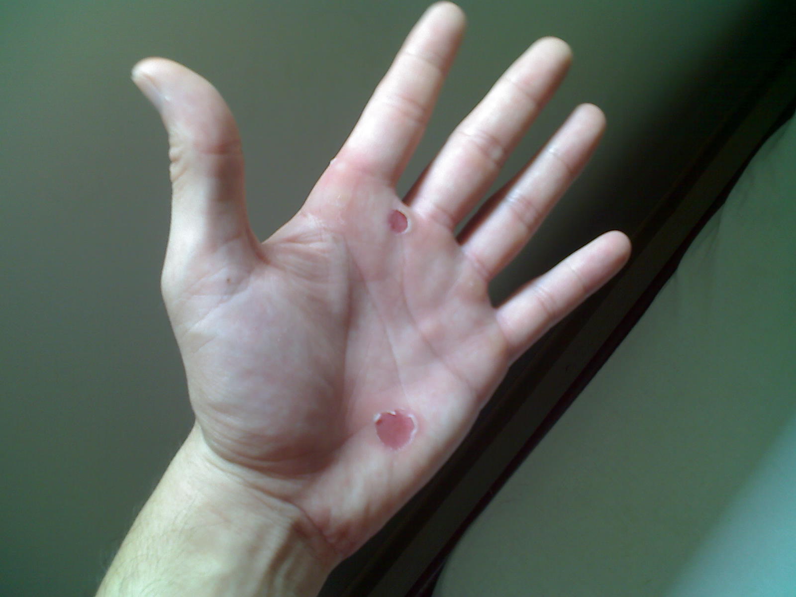 HEALTHYLOG: Flictenas