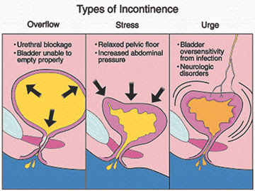 Buku saku keluhan uropoetik (inkontinensia urine) edisi lengkap | Dirza AR