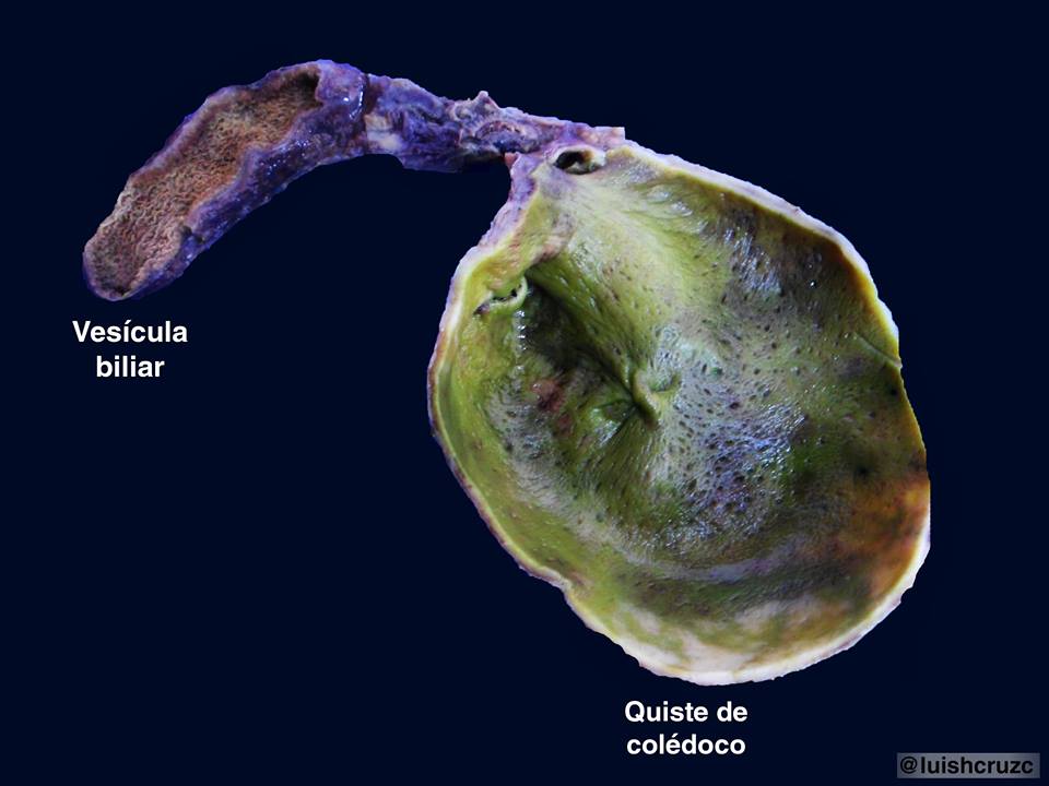 Patología CC: Quiste de colédoco (tipo 1)