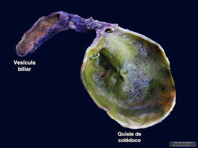 Patología CC: Quiste de colédoco (tipo 1)