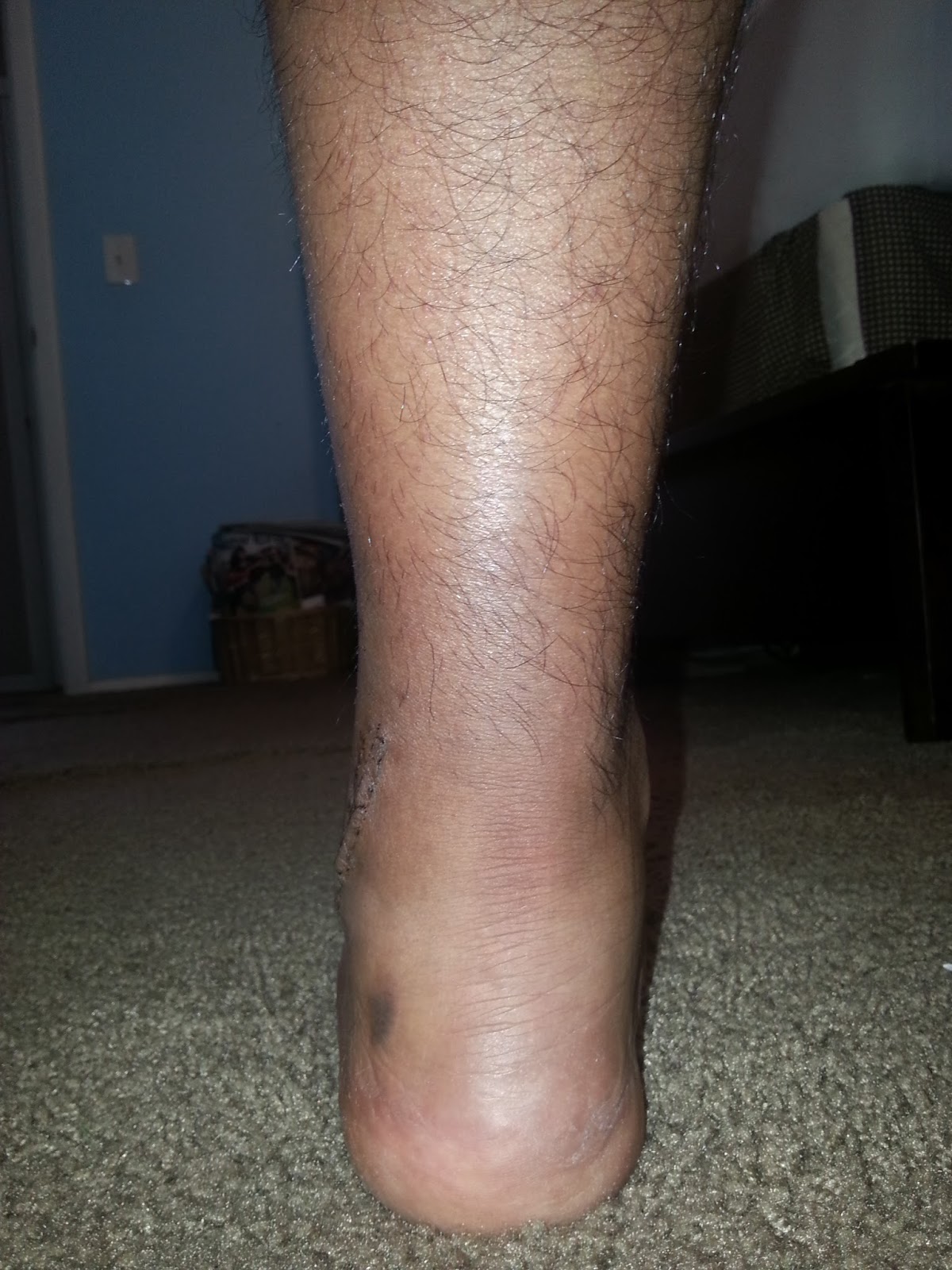 Peroneal Tendon Surgery Recovery: Ankle Time Line (updated for week 10/11)