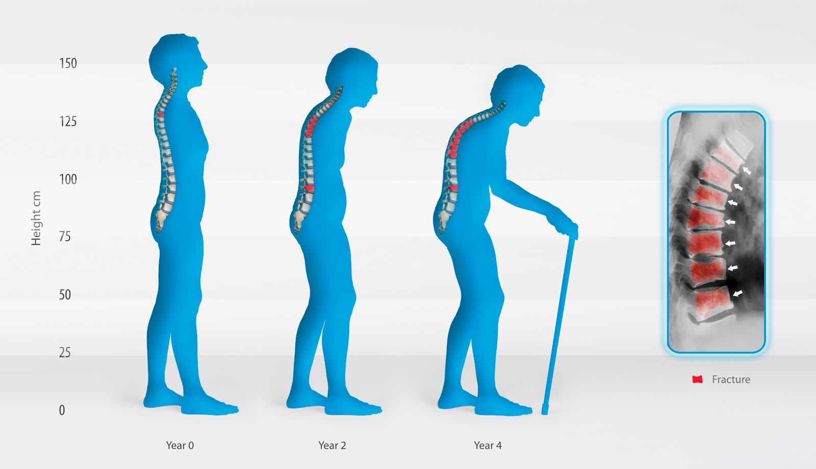 TIPS MENGETAHUI TINGKAT KEPADATAN TULANG DENGAN CEPAT DAN MUDAH ~ INFO ...