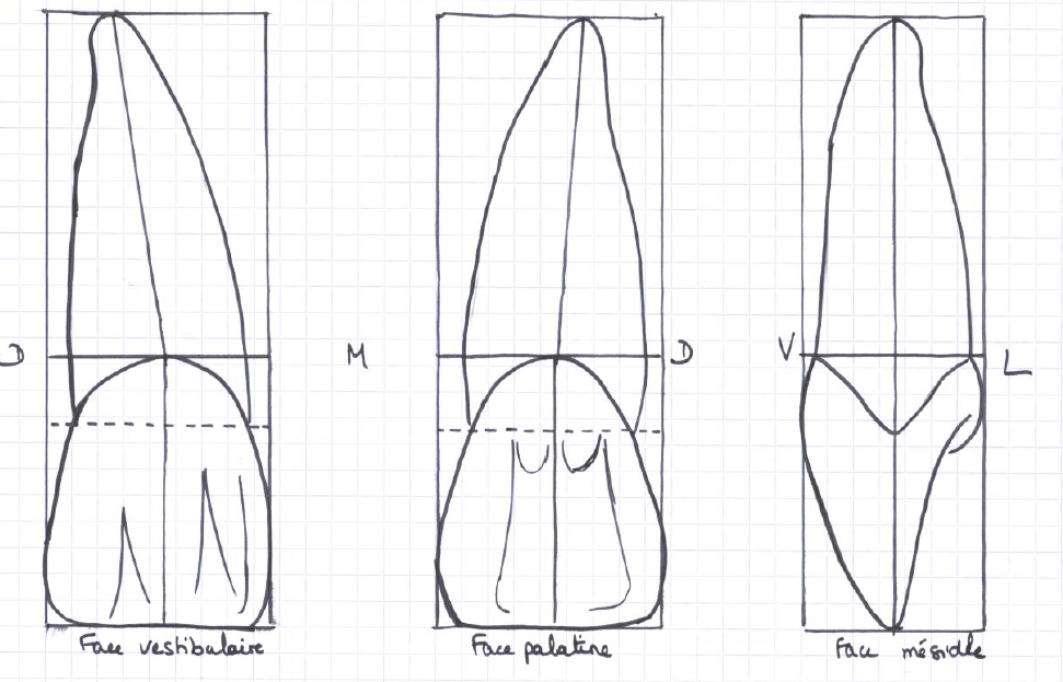 Dentalgate: schemas des faces de l'incisive centrale maxillaire droite