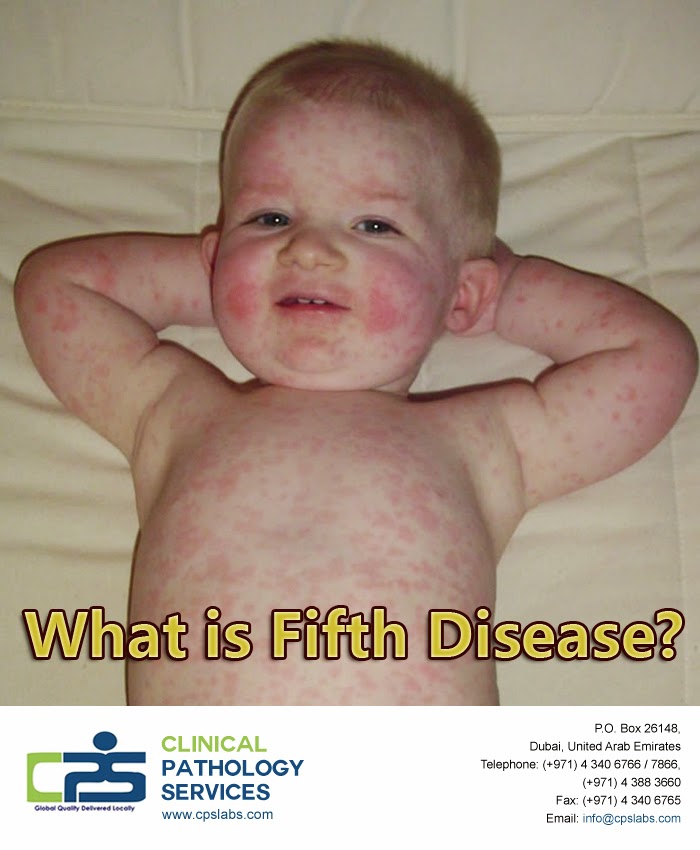 Welcome To Clinical Pathology Services LLC What Is Fifth Disease welcome-to-clinical-pathology-services-llc-what-is-fifth-disease