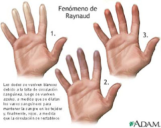 El Alma de la Mariposa: Lupus y la piel