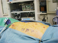 Peritoneoscopy: What happens during an exploratory laparoscopy