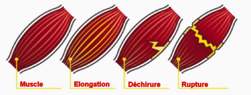 Blog 75: Infos santé : Sport et Santé-Elongation, claquage et déchirure ...