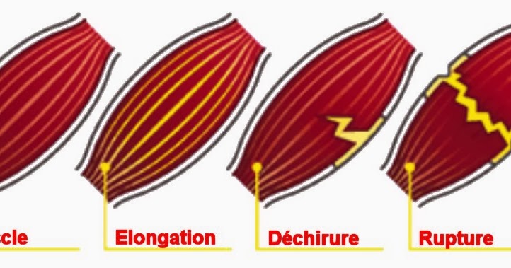Blog 75: Infos santé : Sport et Santé-Elongation, claquage et déchirure ...