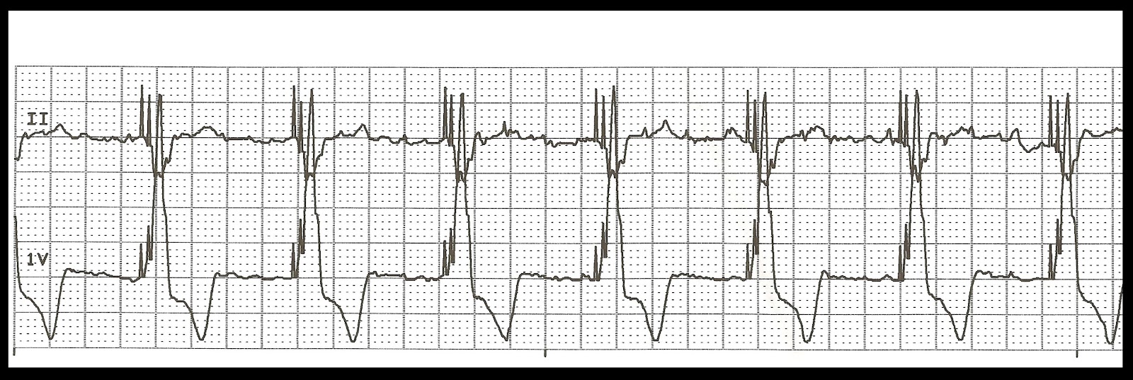 Basic EKG Rhythm Test 29