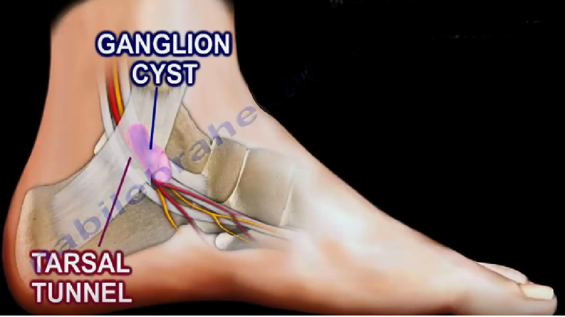 Dr Nabil Ebraheims Blogspot Ganglion Cyst Of The Foot And Ankle