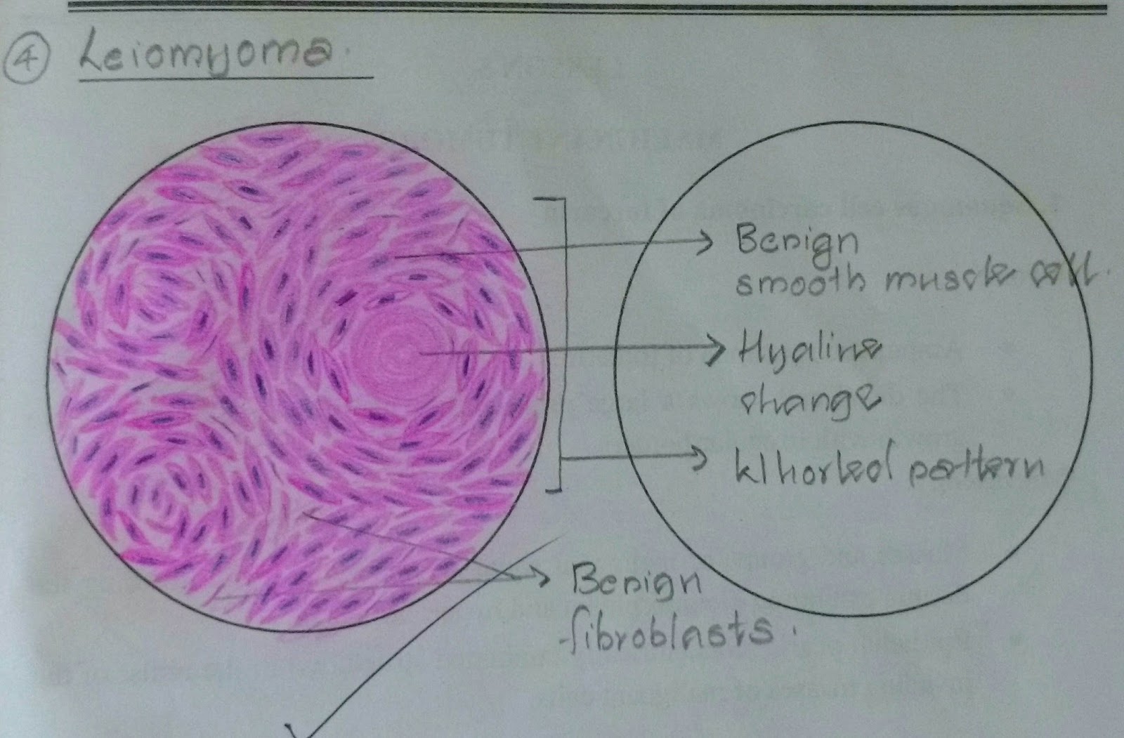 Histopathology Drawings: Leiomyoma