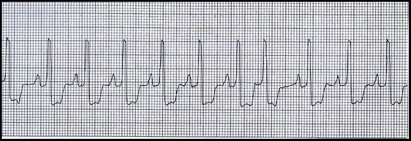 Sinus tachycardia | The Ultimate Curiosity