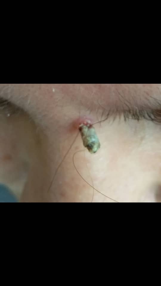 EL RINCÓN DE LA MEDICINA INTERNA: CUERNO CUTÁNEO.