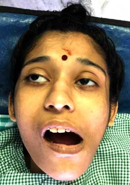 EMINECTOMY TO CORRECT DISLOCATION OF THE CONDYLE - Richardson dental ...