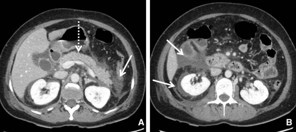 Classification de la pancréatite aigue : mise au point sur les nouveaux ...