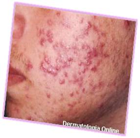Blog da Fa Piazza: Tratamento cosmético da acne vulgar