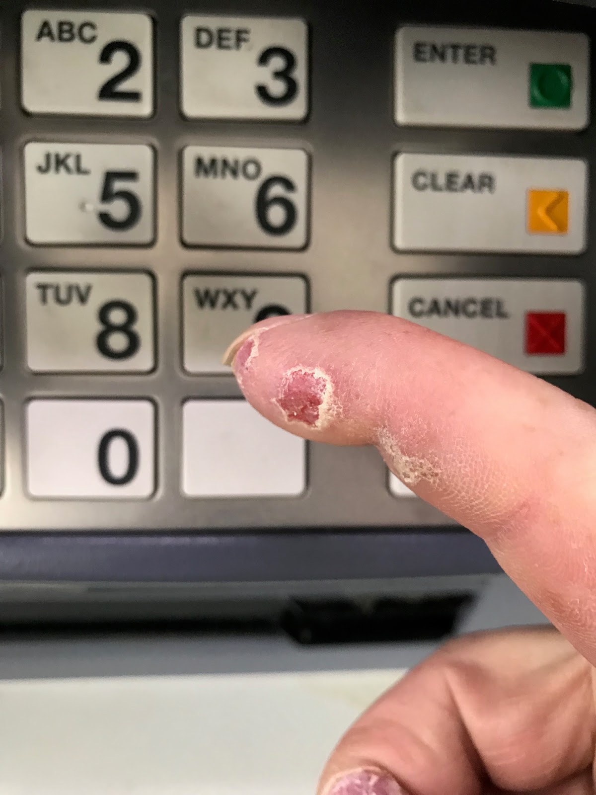 The Hand-Hell Blog - If Your Hands Hurt, Welcome Home!: Hand Hell ...