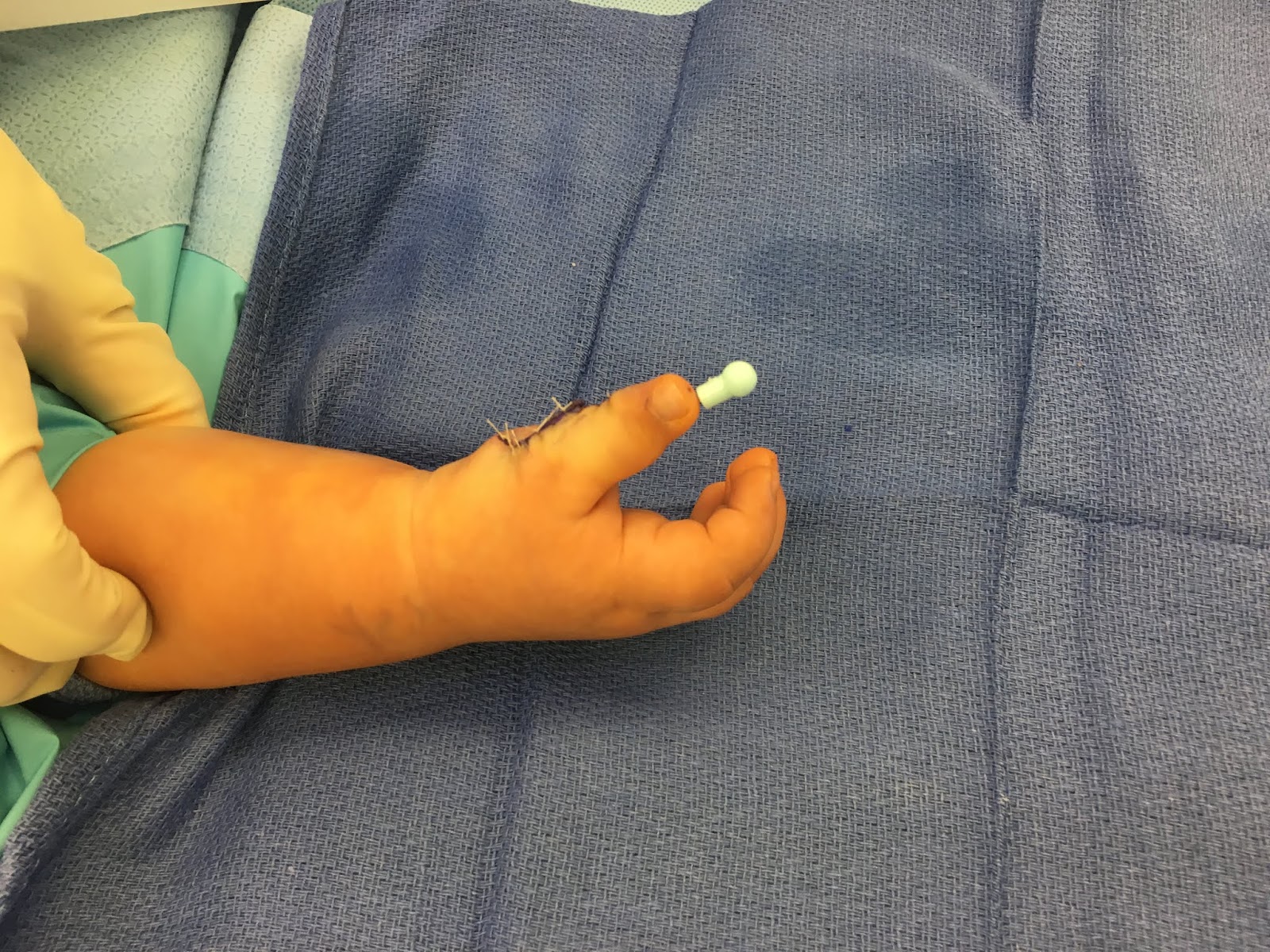 Extra Thumb Reconstruction | Congenital Hand and Arm Differences ...