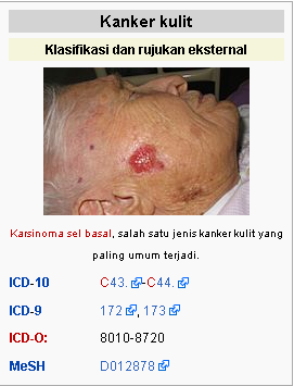 Cara Membedakan Jerawat dan Kanker Kulit