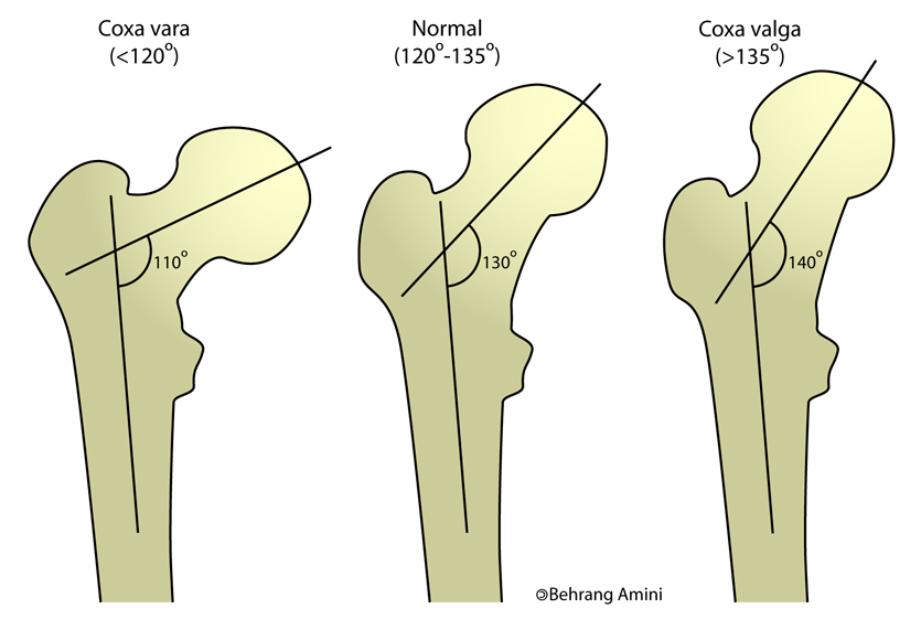 Coxa vara ~ Anatomy for MSP