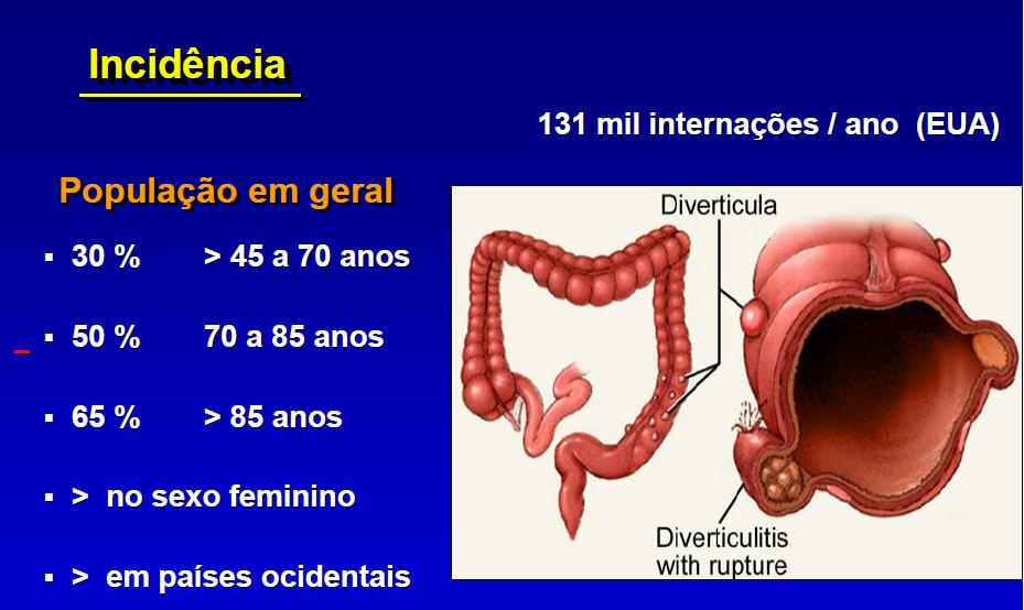 X-RAYview: Doença DIVERTICULAR