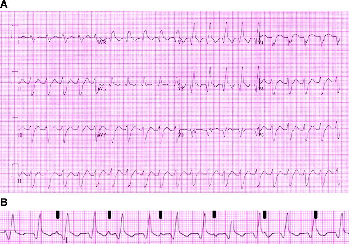松下 ER ランチ・カンファレンス: ルイス誘導 The Lewis Lead