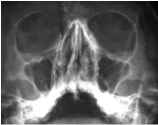 Radiologia de Cara y Cuello: Radiologia de cara y cuello