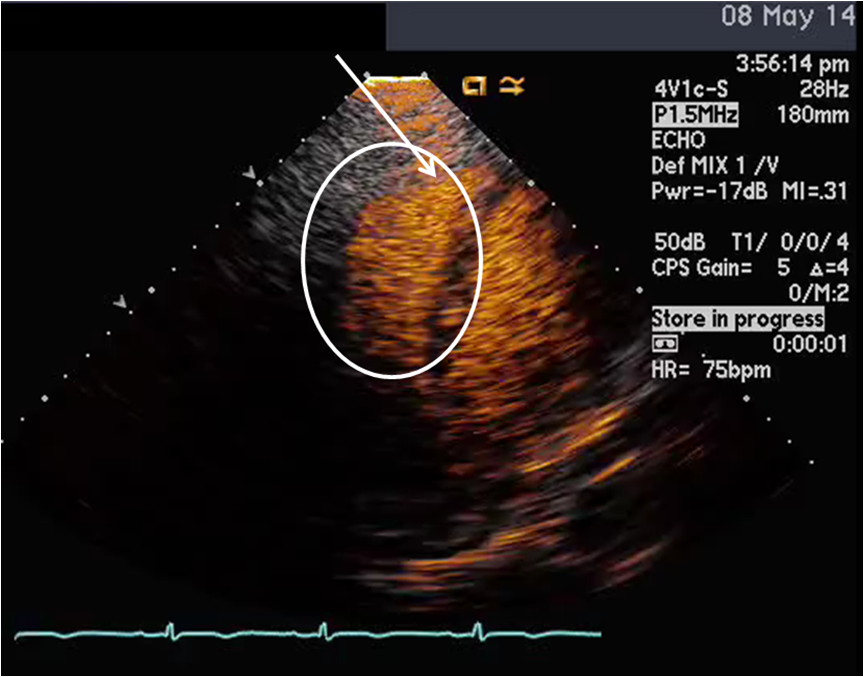 Dr. Smith's ECG Blog: May 2014