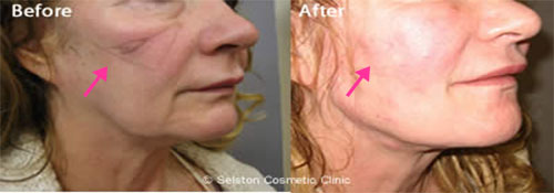Selston Cosmetic Clinic: Cheek Lift for High Cheeks & Facial Volume ...