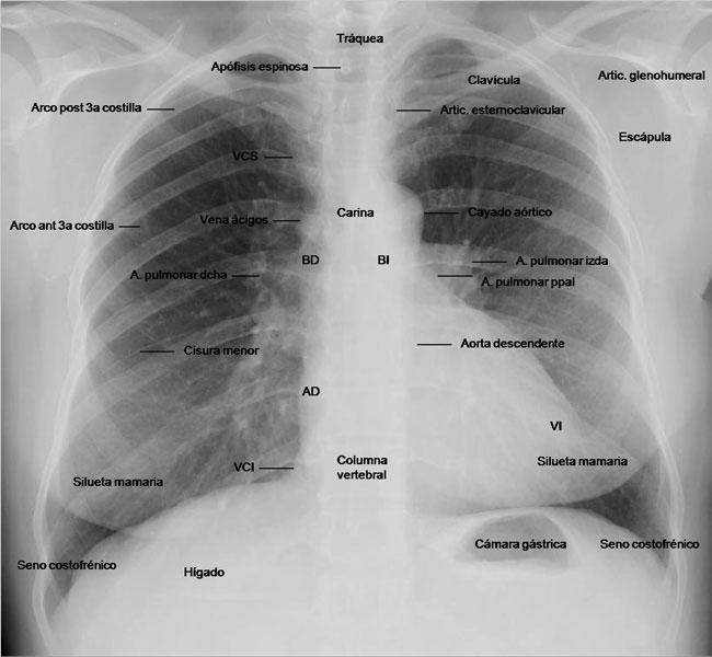 RADIOLOGIA 77: TORAX