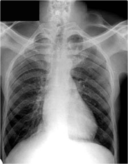 RADIOLOGY IMAGE SPOTTERS: Sprengel's deformity