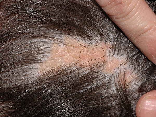 Residentes de familia en Lanzarote.: Carcinoma basocelular sobre un ...