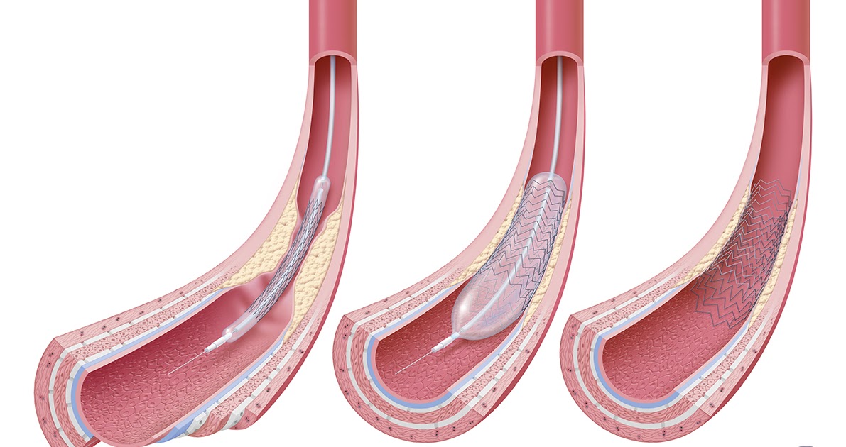 Maria Elena Gonano - PTCA-STENTING