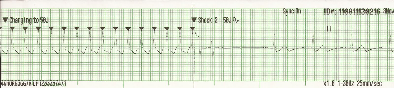 Float Nurse: ACLS review: SVT part 7
