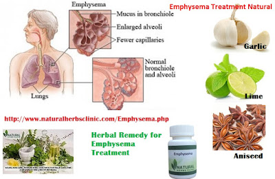 Emphysema Herbal Treatment : Possible Simple Cure for Emphysema