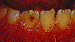 Common Dental Problem And Solution: Discoloration of teeth