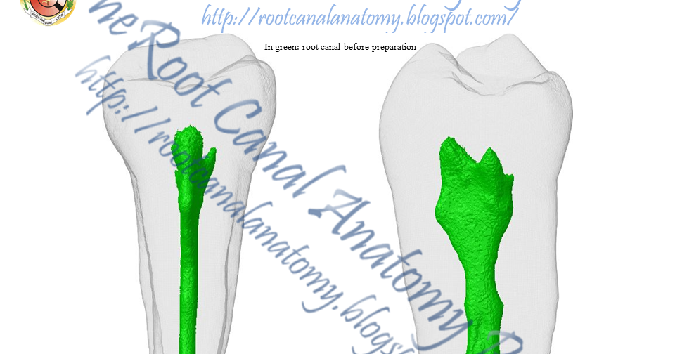 The Root Canal Anatomy Project: Conservative Endodontic Access ...