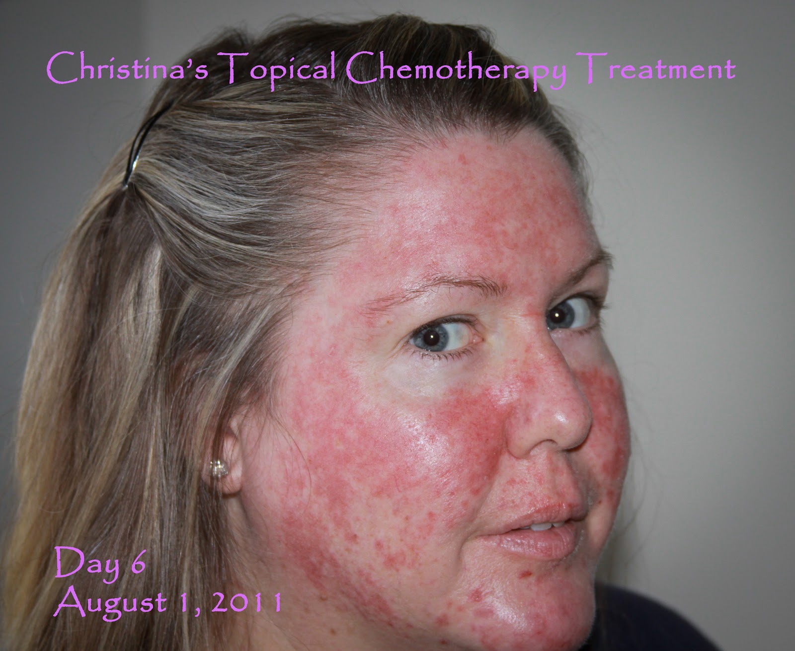 My Journey Through Topical Chemotherapy - Fluorouracil 5% Cream and ...