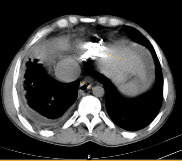 Constrictive Pericarditis-CT - Sumer's Radiology Blog