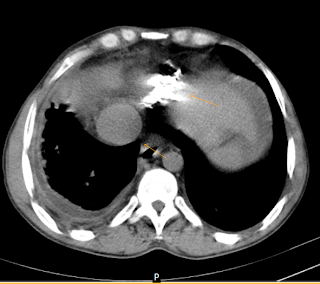 Constrictive Pericarditis-CT - Sumer's Radiology Blog