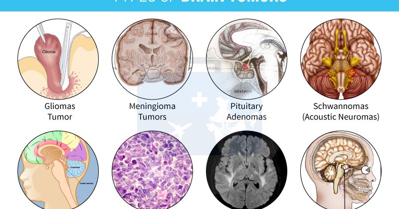 Brain Tumor Surgery: Types and Treatments ~ Healthcare In India