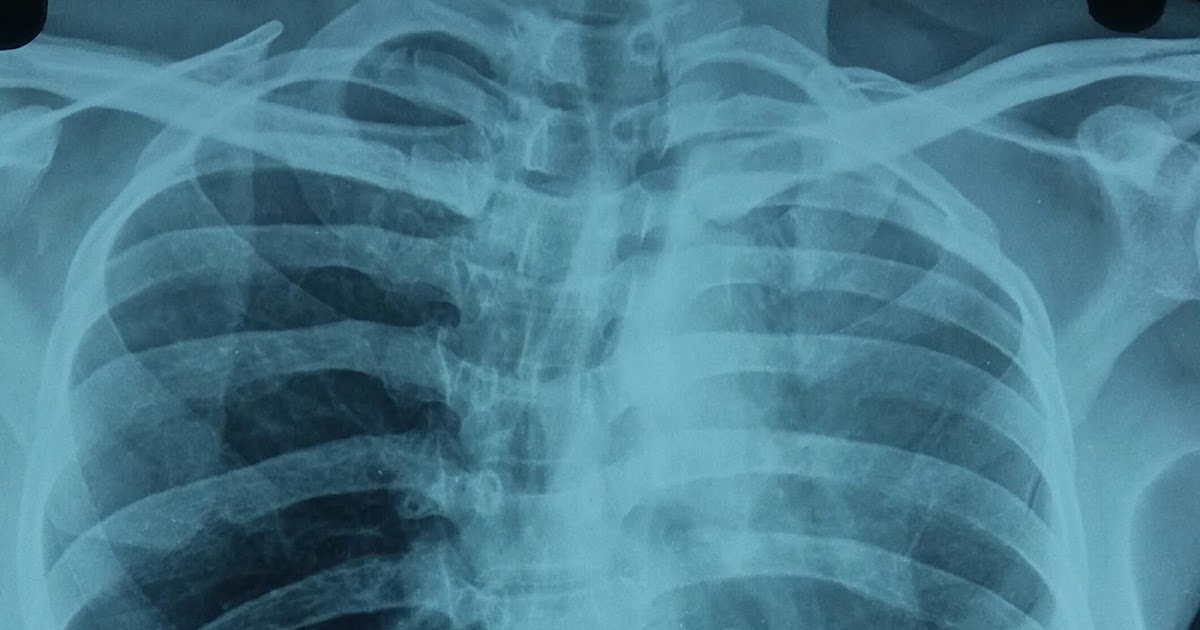 HealthforHeart: Encysted pleural cyst