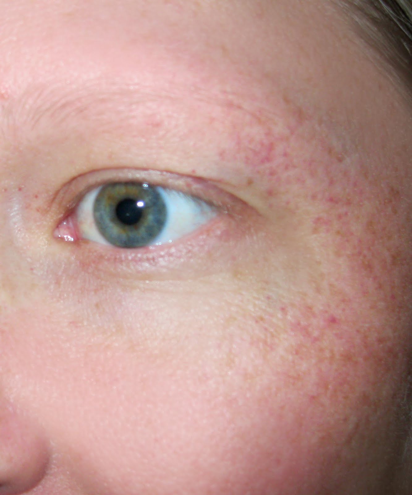 Throwing Up Causing Broken Blood Vessels at Lauren Blackwell blog