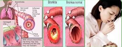 Pengobatan Herbal Bronkitis Kronis